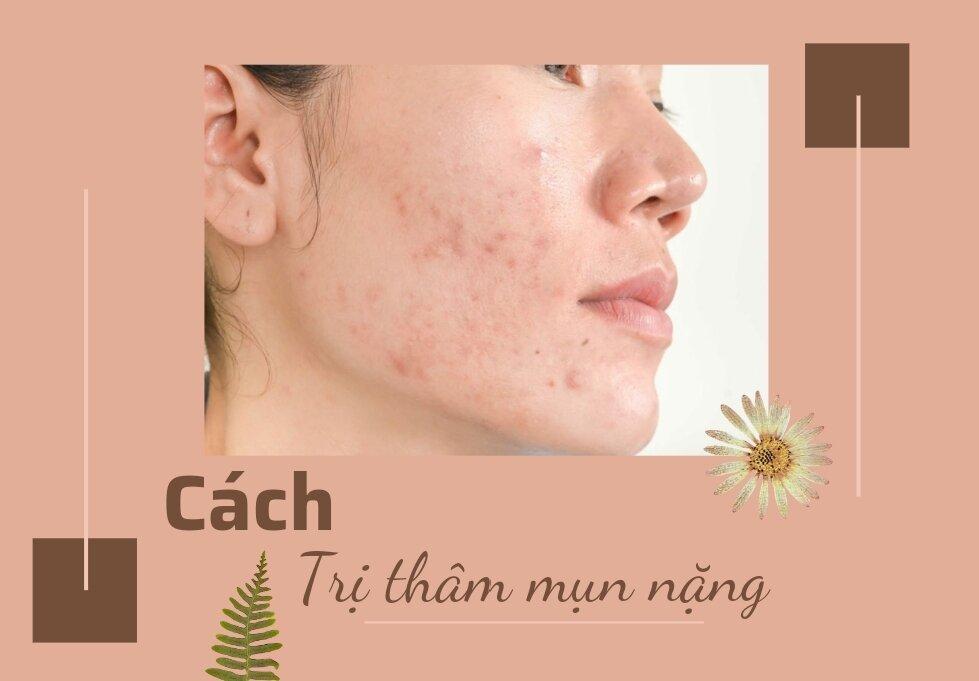 Cách trị thâm mụn nặng an toàn và hiệu quả nhanh chóng nhất - beaudy.vn