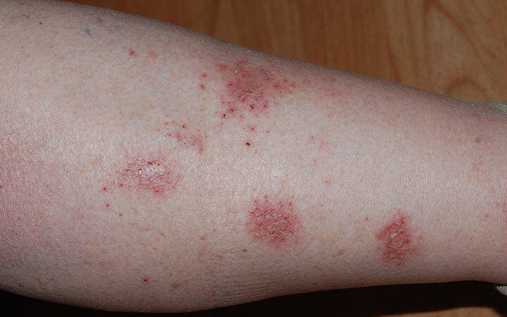 Phát ban da - Điều trị và Cách phòng ngừa an toàn - Beaudy.vn