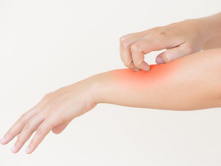 Phát ban da - Điều trị và Cách phòng ngừa an toàn - Beaudy.vn