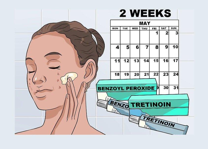 Benzoyl Peroxide là gì? Cách sử dụng Benzoyl Peroxide trị mụn an toàn ...