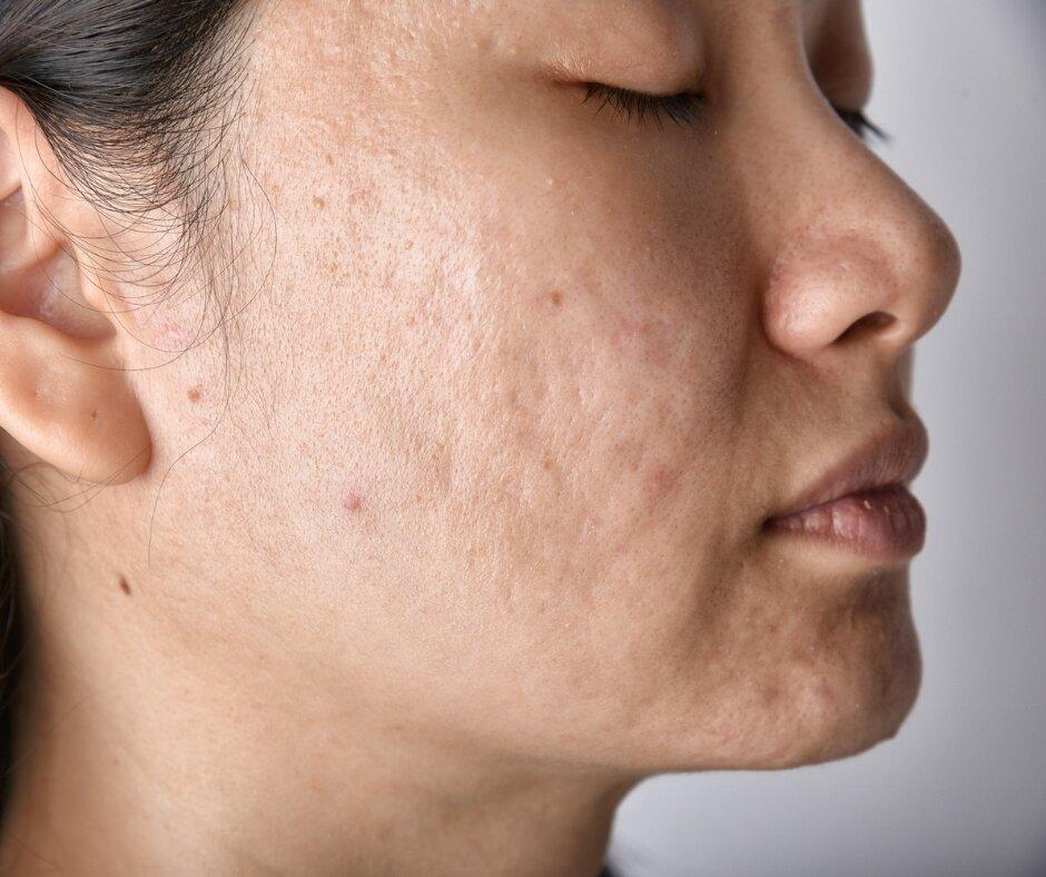 4 tai biến da do Corticosteroid thường gặp: cách nhận biết và phục hồi ...
