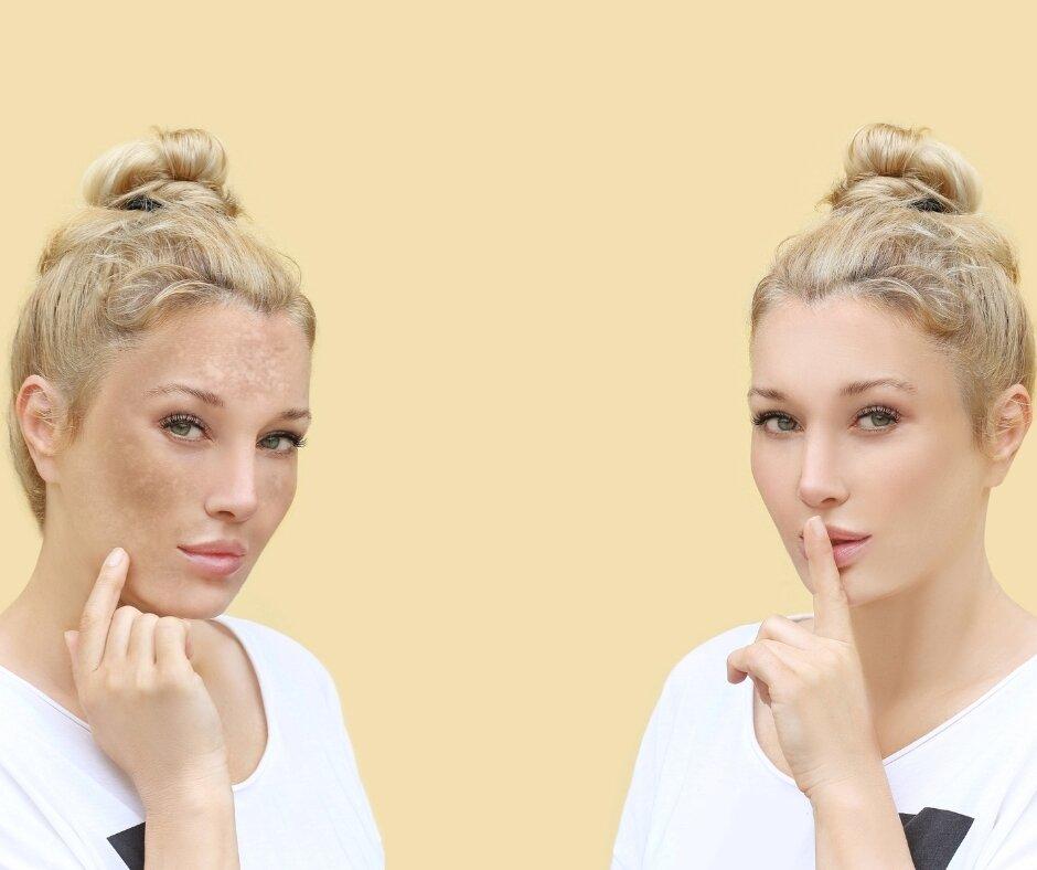 Đốm đồi mồi là gì? Nguyên nhân, cách nhận biết, điều trị và ngăn ngừa ...