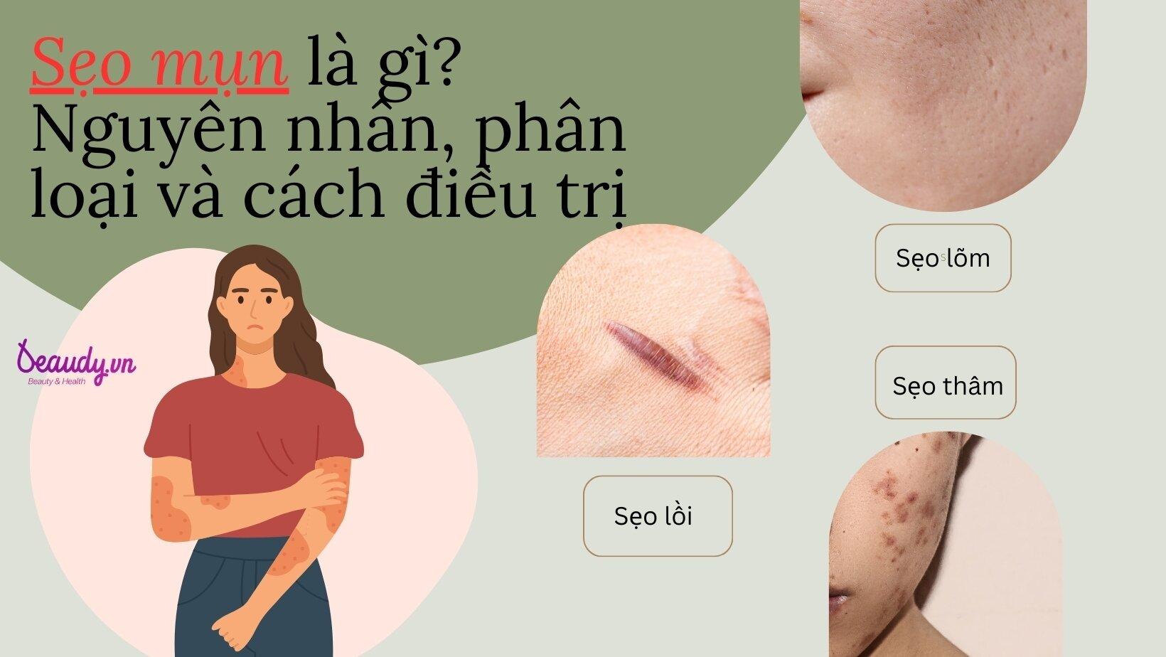 Sẹo mụn là gì? Nguyên nhân, phân loại và cách điều trị sẹo mụn hiệu quả ...