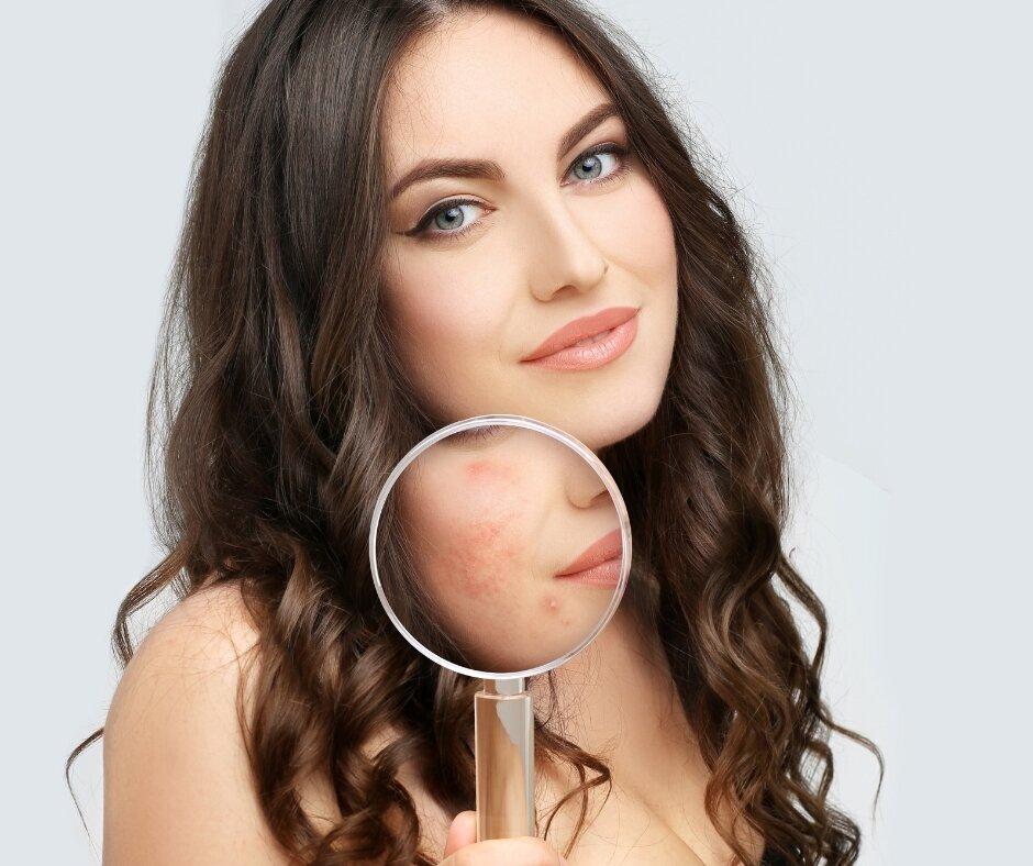 Sẹo mụn là gì? Nguyên nhân, phân loại và cách điều trị sẹo mụn hiệu quả ...