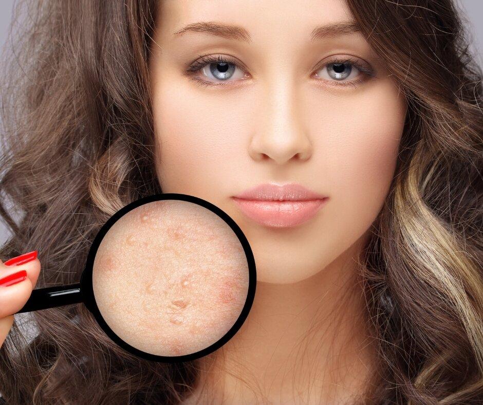 Sẹo mụn là gì? Nguyên nhân, phân loại và cách điều trị sẹo mụn hiệu quả ...