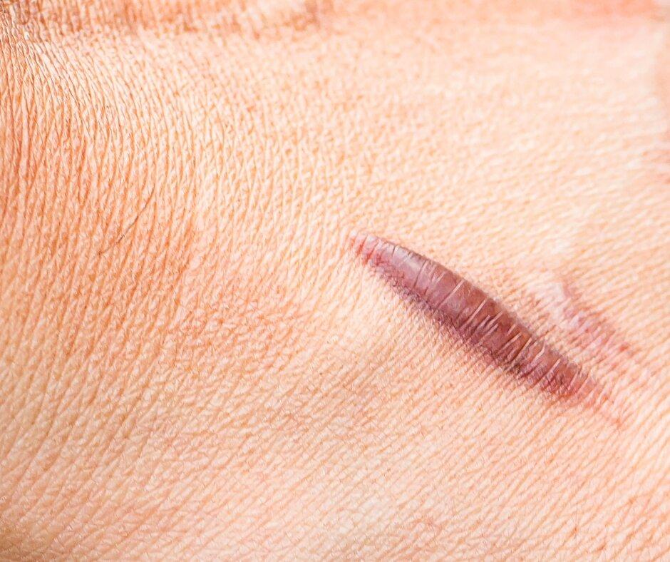 Sẹo mụn là gì? Nguyên nhân, phân loại và cách điều trị sẹo mụn hiệu quả ...