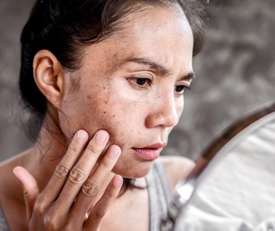 Sẹo mụn là gì? Nguyên nhân, phân loại và cách điều trị sẹo mụn hiệu quả ...