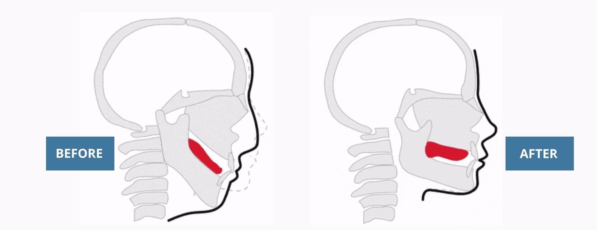 Phương pháp Mewing là gì? Cách áp dụng Mewing đúng cách và giúp mặt ...